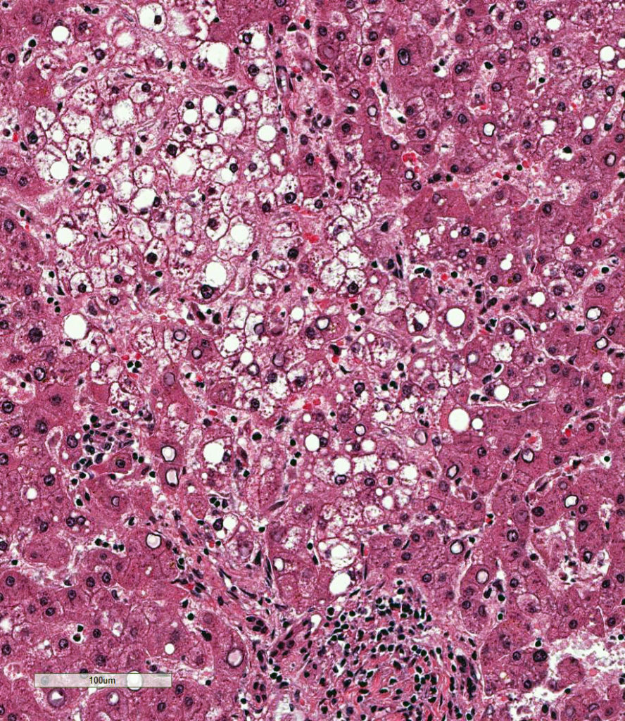 NASH Liver tissue sample for research - Lab-Ally NASH Liver tissue sample for research - Lab-Ally